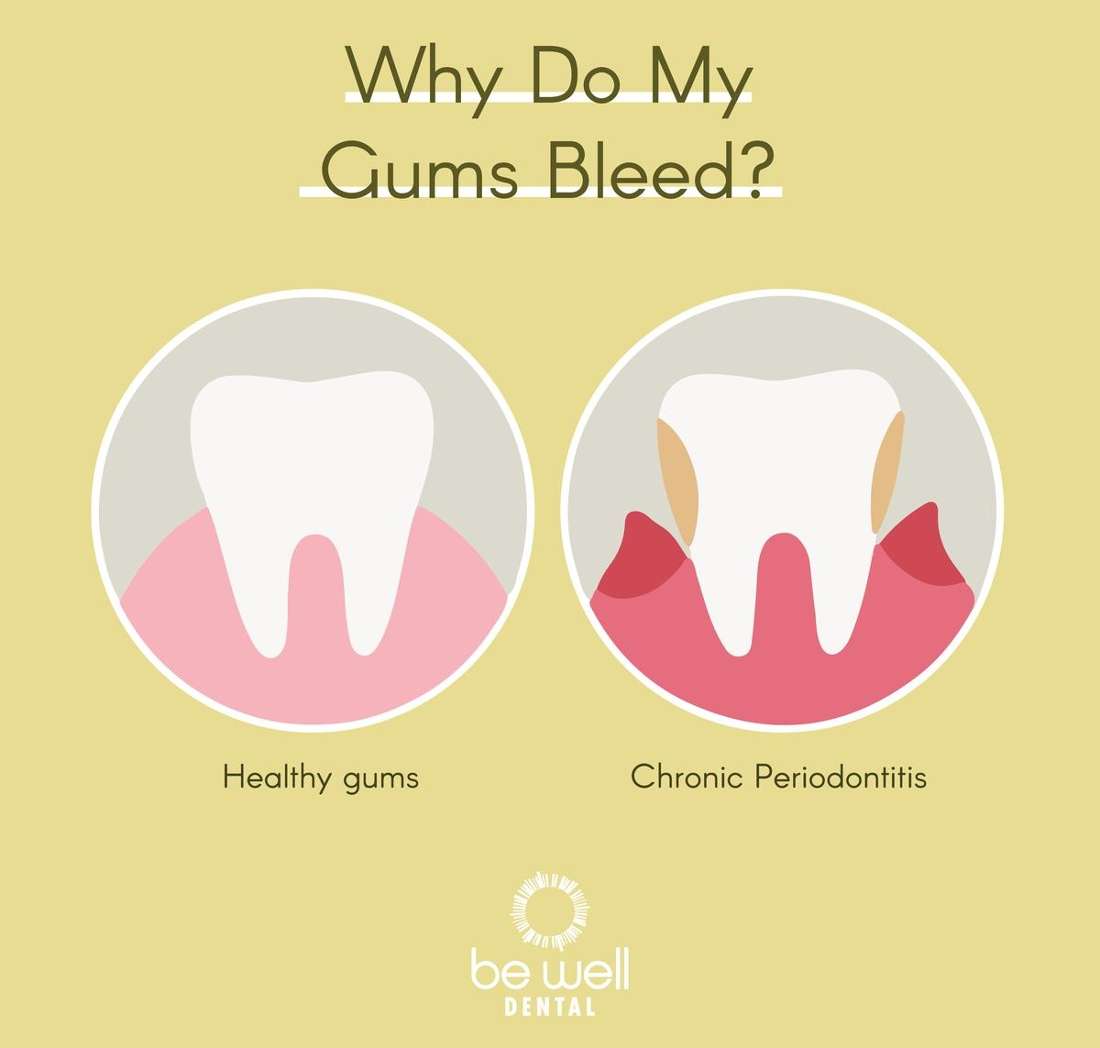 Be Well Dental Blog | Why do my gums bleed when I clean my teeth?